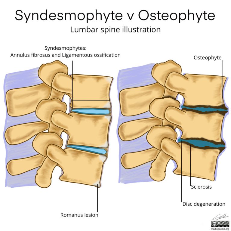 The elderly can do more exercise to prevent osteophytes – DeQsb